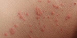 Why do I get chlorine rash after swimming? | Virtuwell