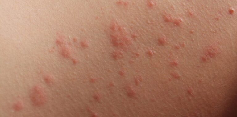 Why do I get chlorine rash after swimming? | Virtuwell