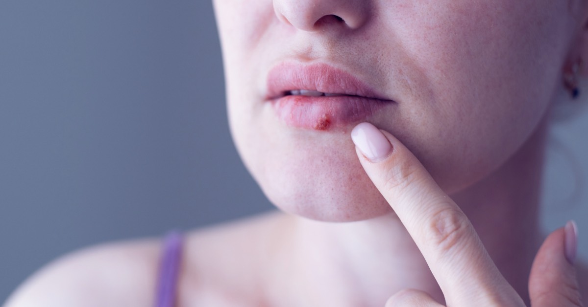 Cold sores: What you need to know | Virtuwell